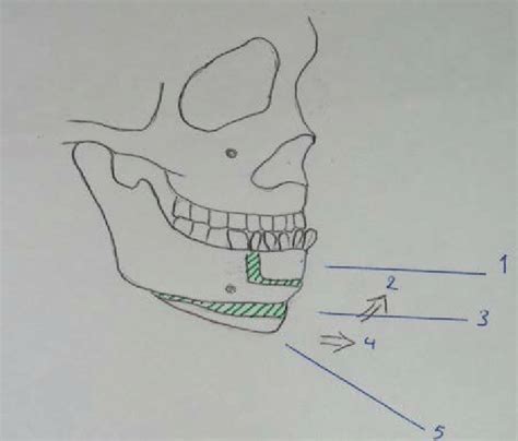Schematic Representation Of Surgical Technique 1 Mandibular Segmental Download Scientific