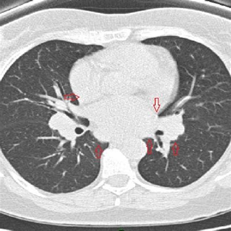 Mediastinal Lymph Node Biopsy Indicate Noncaseating Epithelioid Cell Download Scientific