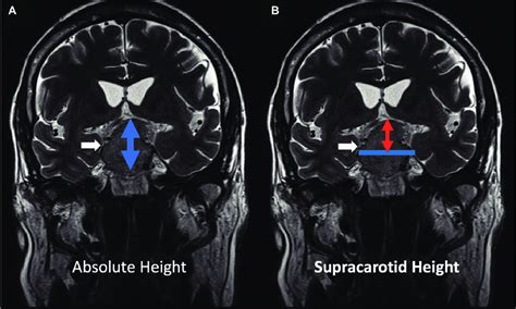 A And B Measurement For The Vertical Compression Representing