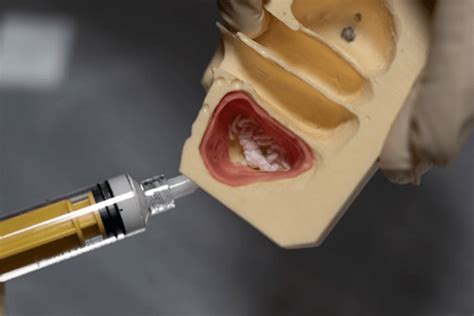 Paradigm Shift Sinus Augmentation With Sinus Membrane Removal