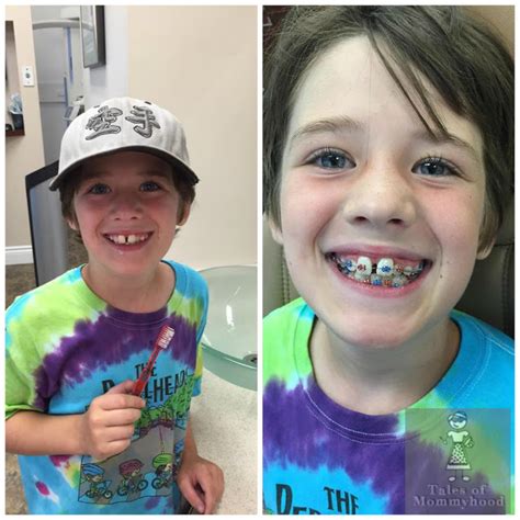 Tales Of Mommyhood Mr Js Orthodontic Adventure