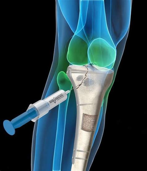 Injectable Bone Graft Substitutes Market To Witness Widespread Expansion During 2018 To 2028