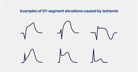 Stemi Ecg Criteria Key Insights Into Ischemic St Elevation Patterns