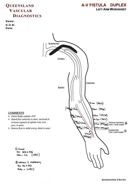 Upper Av Fistula Worksheet Arteries Ultrasound Extremity Worksheets Duplex Venous Vascular Limb