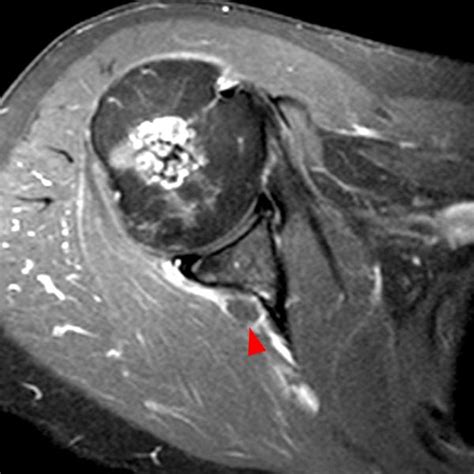 Shoulder Cysts Radsource