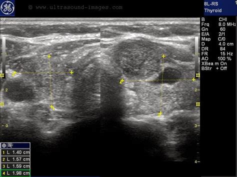 Hypoechoic Nodule With High Risk Of Malignancy ~ Ultrasound Cases Info