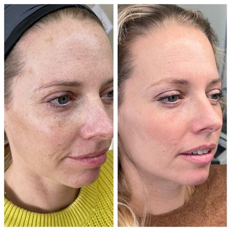 Bbl In Missoula Transform Your Skin With Broadband Light