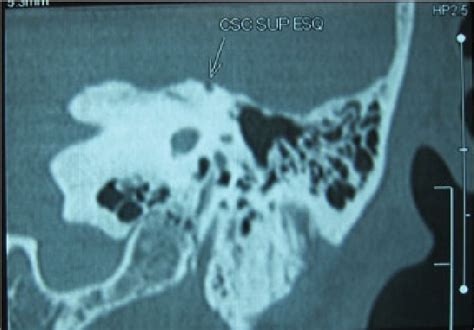 Left Superior Semicircular Canal Dehiscence As Seen On Coronal Temporal