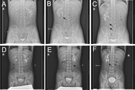 A C From Patient No 6 A Renal Collecting System Developed Within 10