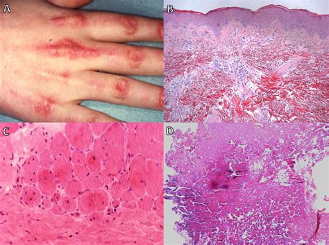Characteristic Gottrons Papules In The Fingers Joints A