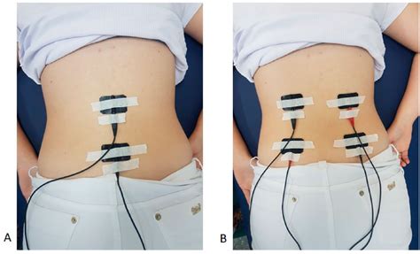 Figure 1 From Evaluation Of Interferential Current Adaptation In