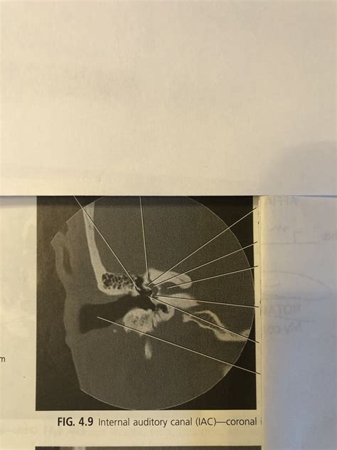 Iac Anatomy Coronal Diagram Quizlet