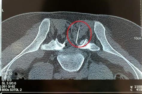 Ct Prt Meine Erfahrungen Mit Den Spritzen Meine Bandscheibe De