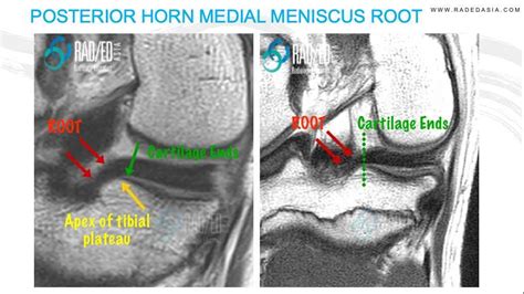 Knee Mri Meniscus Root Tear Where To Look Radiology Education Asia