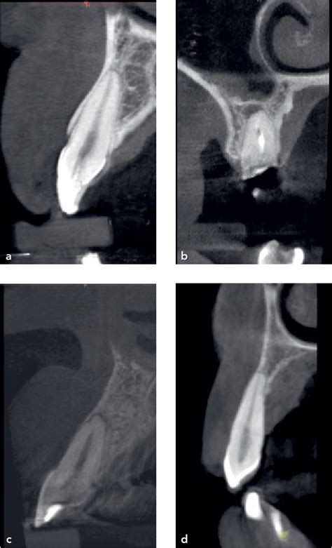 Figure 3 From A Clinical Classification System For The Treatment Of Postextraction Sites