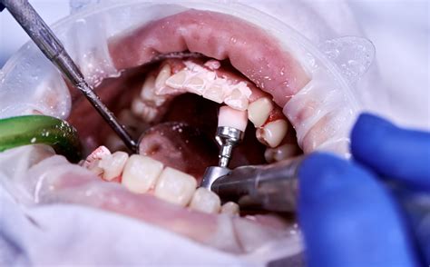 Reversible And Irreversible Pulpitis Symptoms And Treatments Dr