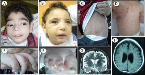 A Patient Iv I Facial Appearance Note Bitemporal Narrowing Long