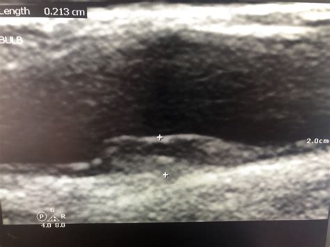 Carotid Ultrasound Imt And Plaque Assessment — Whole Heart Cardiology