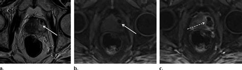 Prostatic Abscess In A 60 Year Old Man Following Transrectal Prostate Download Scientific