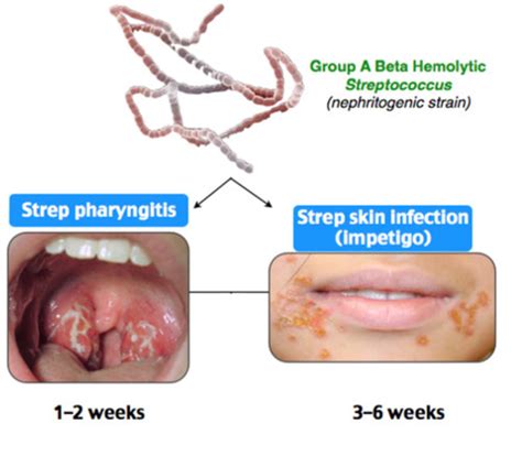 Pa 527 Glomerular Disorders Flashcards Quizlet