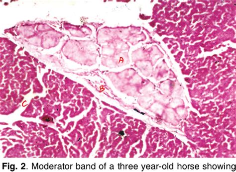 Moderator Band Histology