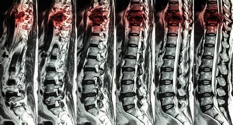 Thoracic Spine Fracture And Spinal Cord Compression Shown In Mri Photo