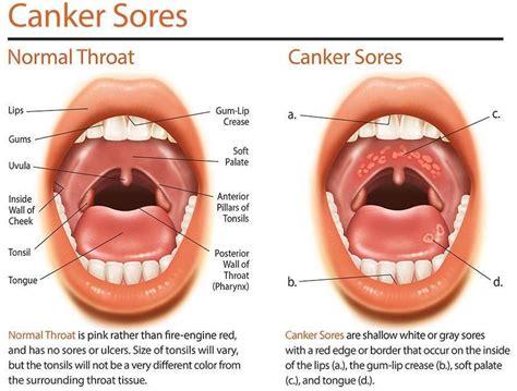 Canker Sore Inside Cheek