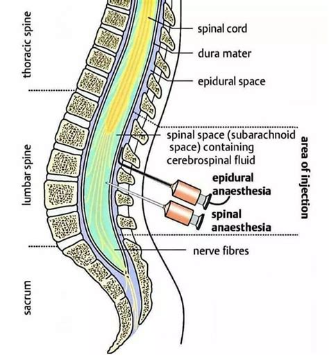 Epidural And Spinal Anaesthesia Medizzy