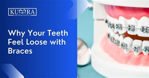 Why Your Teeth Feel Loose With Braces Kumra Orthodontics
