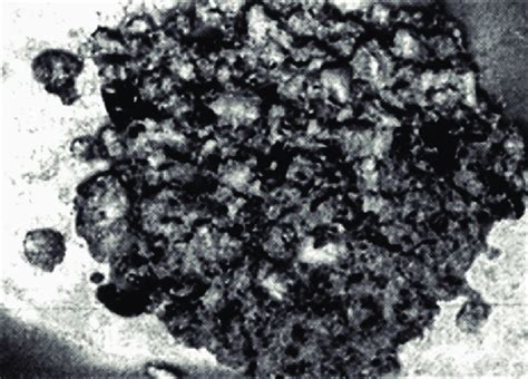 Gross Photograph Of The Specimen Showing Multiple Small Bits Of Friable