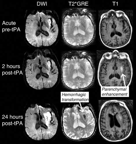 Stroke Brain Mri