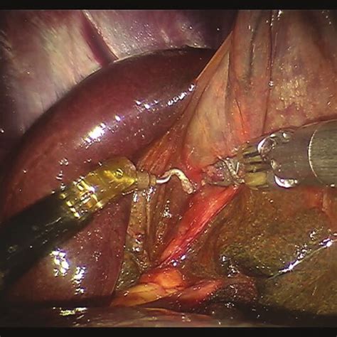 Diagram Of Port Placement For Robotic Cholecystectomy Port 1 12 Mm