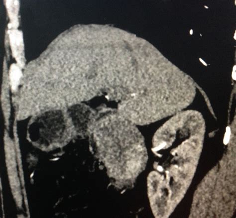 Vietnamese Medic Ultrasound Case 369 Duodenum Tumor Dr Phan Thanh