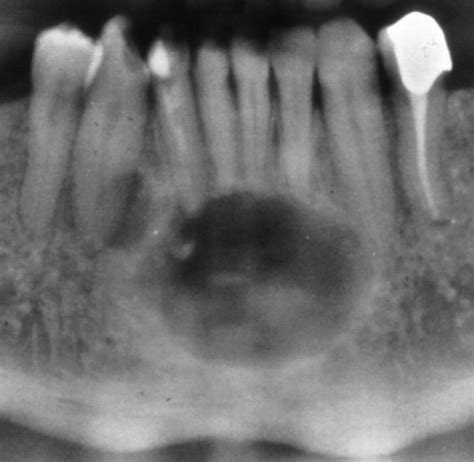 Radicular Cyst Radiology