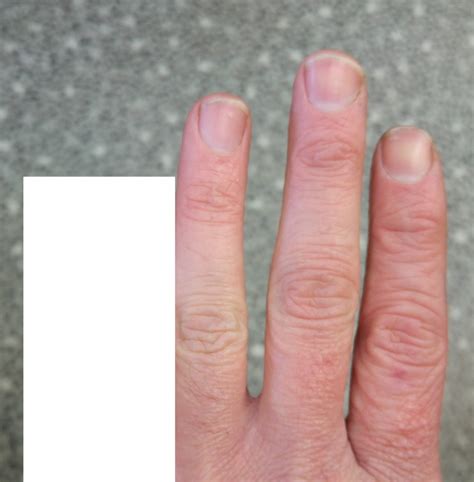 Este Incredibil Cum I Se Transformă Degetul Mic De Fiecare Dată Când Se Schimbă Vremea