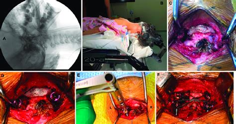 Intraoperative Fluoroscopy Showing The Attempt At Using The Transoral
