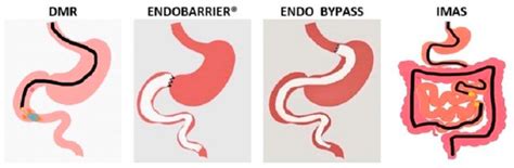 A Comprehensive Review On Bariatric Endoscopy Where We Are Now And Where We Are Going Pmc