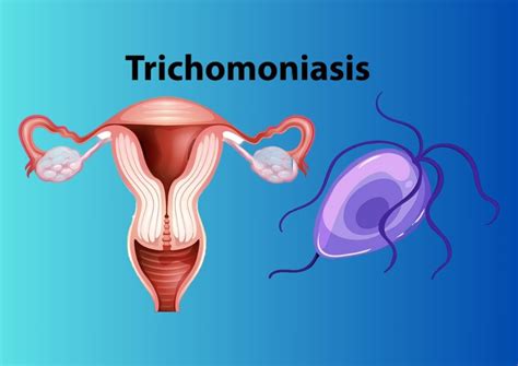 Trichomoniasis Treatment Vitalhousecall