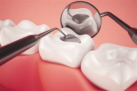 Safe Amalgam Removal Silver Fillings Removal Galliano Dental Office