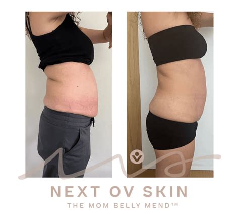 Non Surgical Mommy Makeover Edmonds Wa No Surgery No Downtime