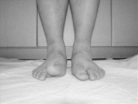 The Contracture Of Ehl Tendon Leaded To Extension At The Meta