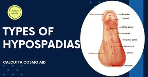 Types Of Hypospadias Explained In 5 Simple Steps