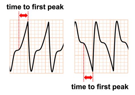 Basel Algorithmとは？ 心電図