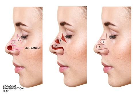 Face Cancer Surgery Tauranga Rotorua Nose Cancer Surgery Nz