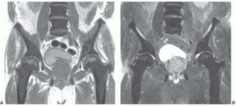 Diffuse Marrow Diseases Musculoskeletal Key