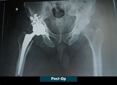 Primary Hip Replacement Surgery Ahmedabad Dr Rachit Sheth