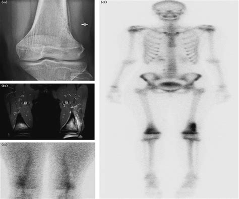 Chronic Recurrent Multifocal Osteomyelitis Typical Patterns