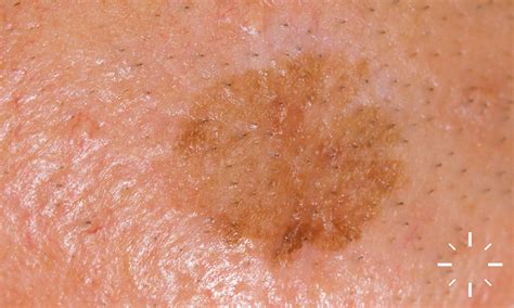 Dermacompass Lentigo Simplex Lentigo Solaris