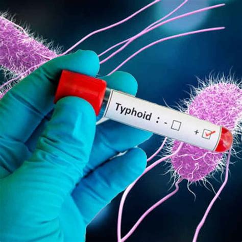 Typhoid Fever According To New Research Typhoid Fever Is Evolving Extensive Drug Resistance