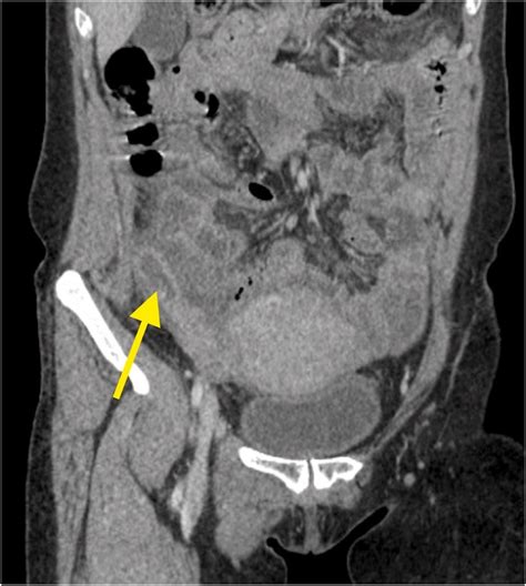 Recurrent Appendicitis Of Vermiform Appendix After A Prior Appendectomy